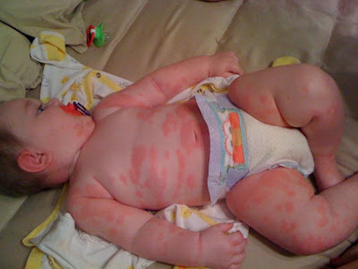 Baby Rash Pictures Causes Treatments Mommyhood101
