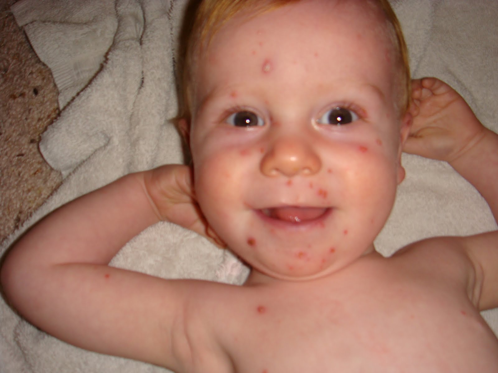 Baby Rash Pictures Causes Treatments Baby Baby Pictur Vrogue co Baby Rash Pictures Causes Treatments Baby Baby Pictur Vrogue co
